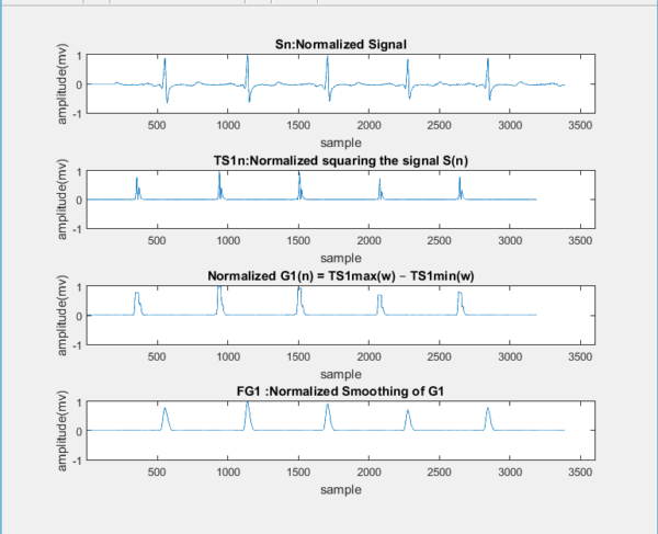 فروش پروژه تشخیص Qrs در سیگنال Ecg با نرم افزار Matlab انجام پروژه